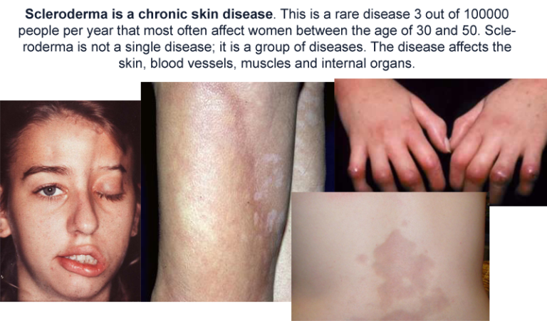 All about scleroderma disease - Health and safety training community