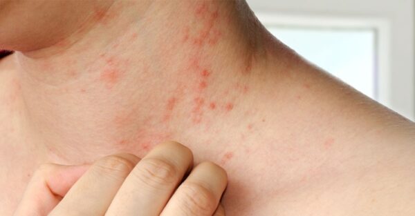 Dermatitis causes, symptoms and treatment