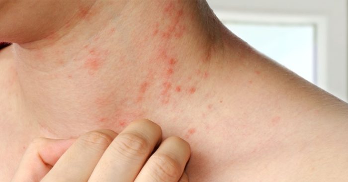 Dermatitis causes, symptoms and treatment